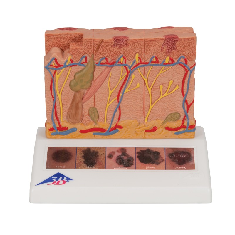 3B Scientific Magnified Skin Cancer Model | Health and Care